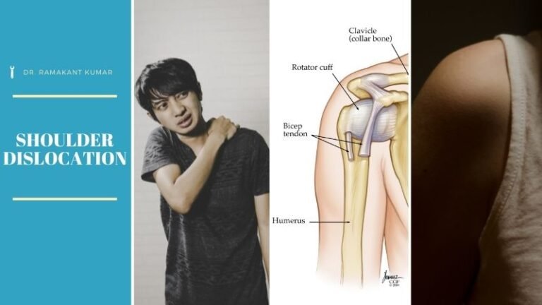 Shoulder Dislocation Types ( Recurrent Shoulder Dislocation )